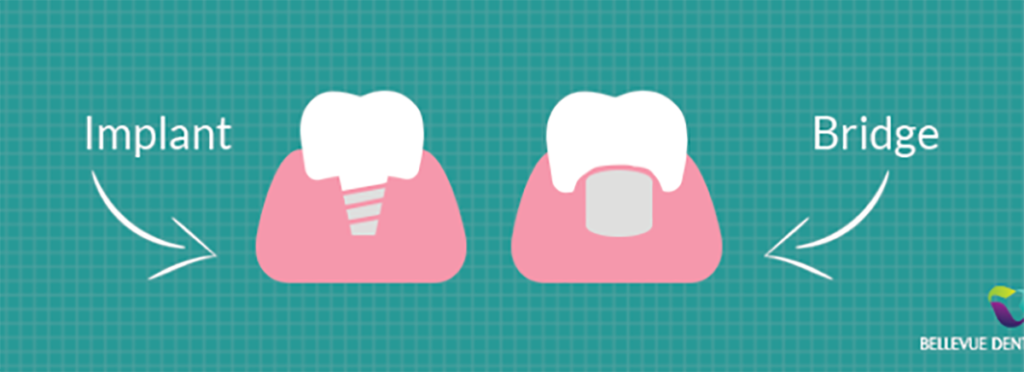 Benefits of an Implant versus a Bridge
