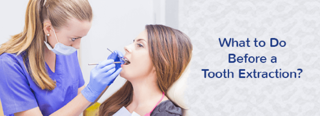 What to Do Before a Tooth Extraction? - Longevity Expertise